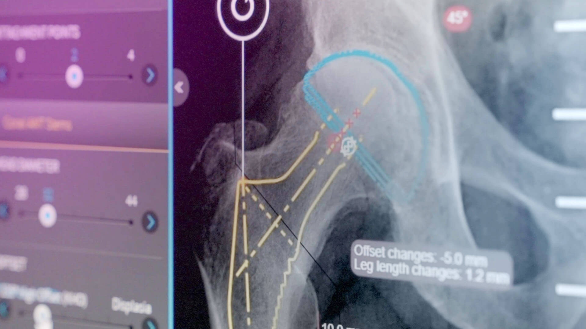 Surgery Products: Cutting-Edge for Precision Surgery | Brainlab