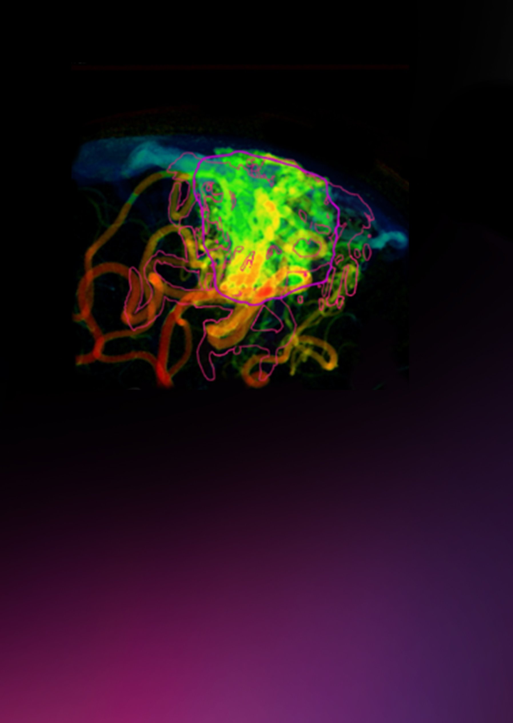 Cranial Radiosurgery: Elements Software for Cranial SRS | Brainlab