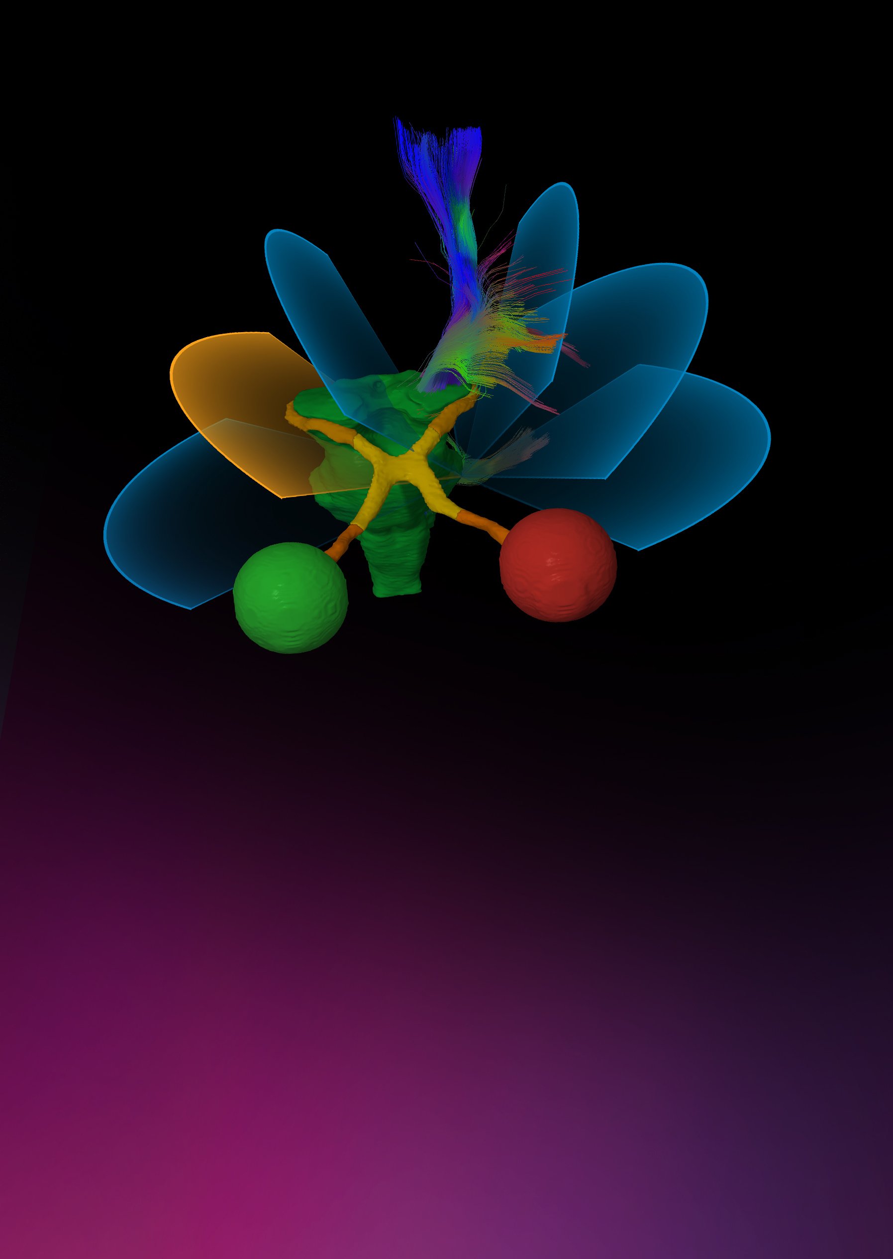 Cranial Radiosurgery: Elements Software for Cranial SRS | Brainlab