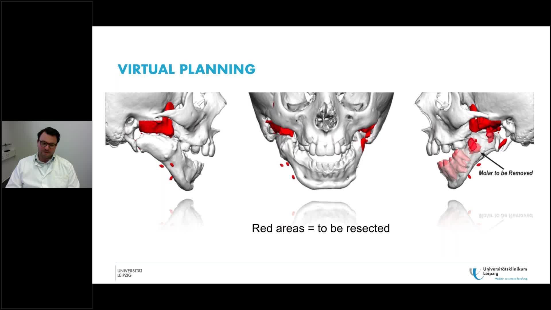 Intraoperative Real-time Navigation and Intraoperative 3D | Brainlab
